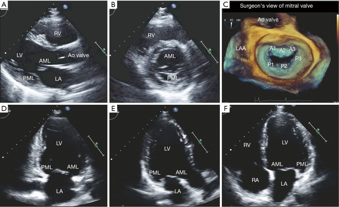 Transesophageal Echocardiography Detail Of Anterior M - vrogue.co Transesophageal Echocardiography Detail Of Anterior M - vrogue.co