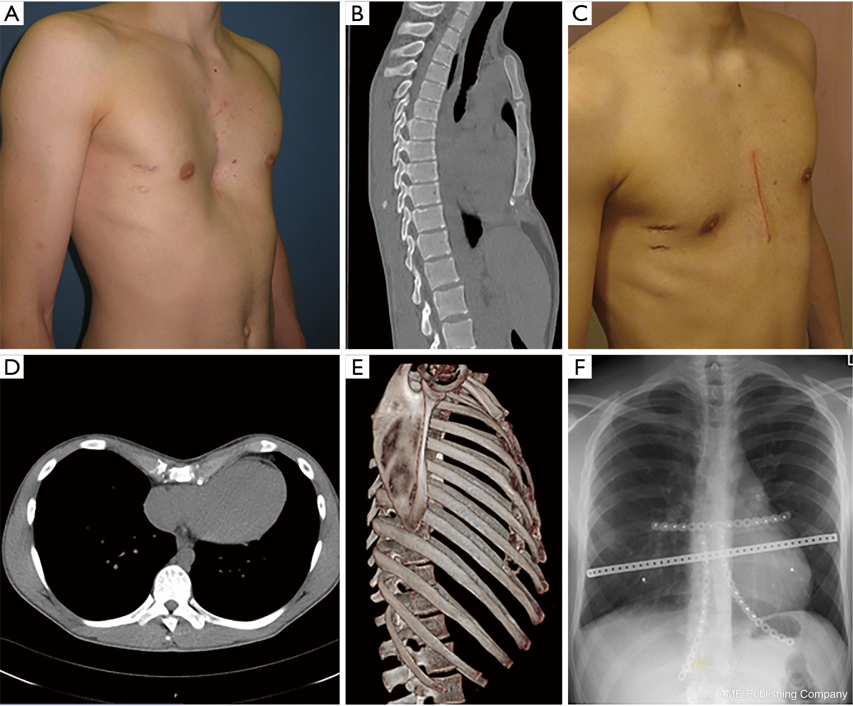 My Pectus Excavatum Funnel Chest Nuss Procedure Read Abnormalities In