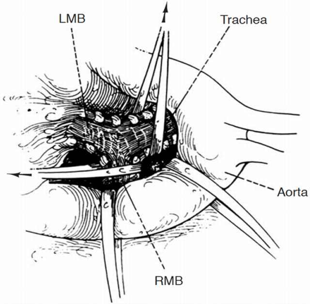 Carinal resections - Tapias- Annals of Cardiothoracic Surgery