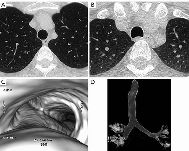 Imaging of the trachea - Shepard- Annals of Cardiothoracic Surgery