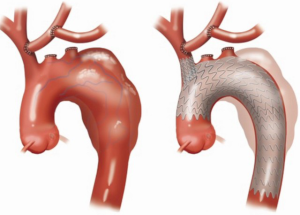 Double transposition and single branched TEVAR for total arch ...