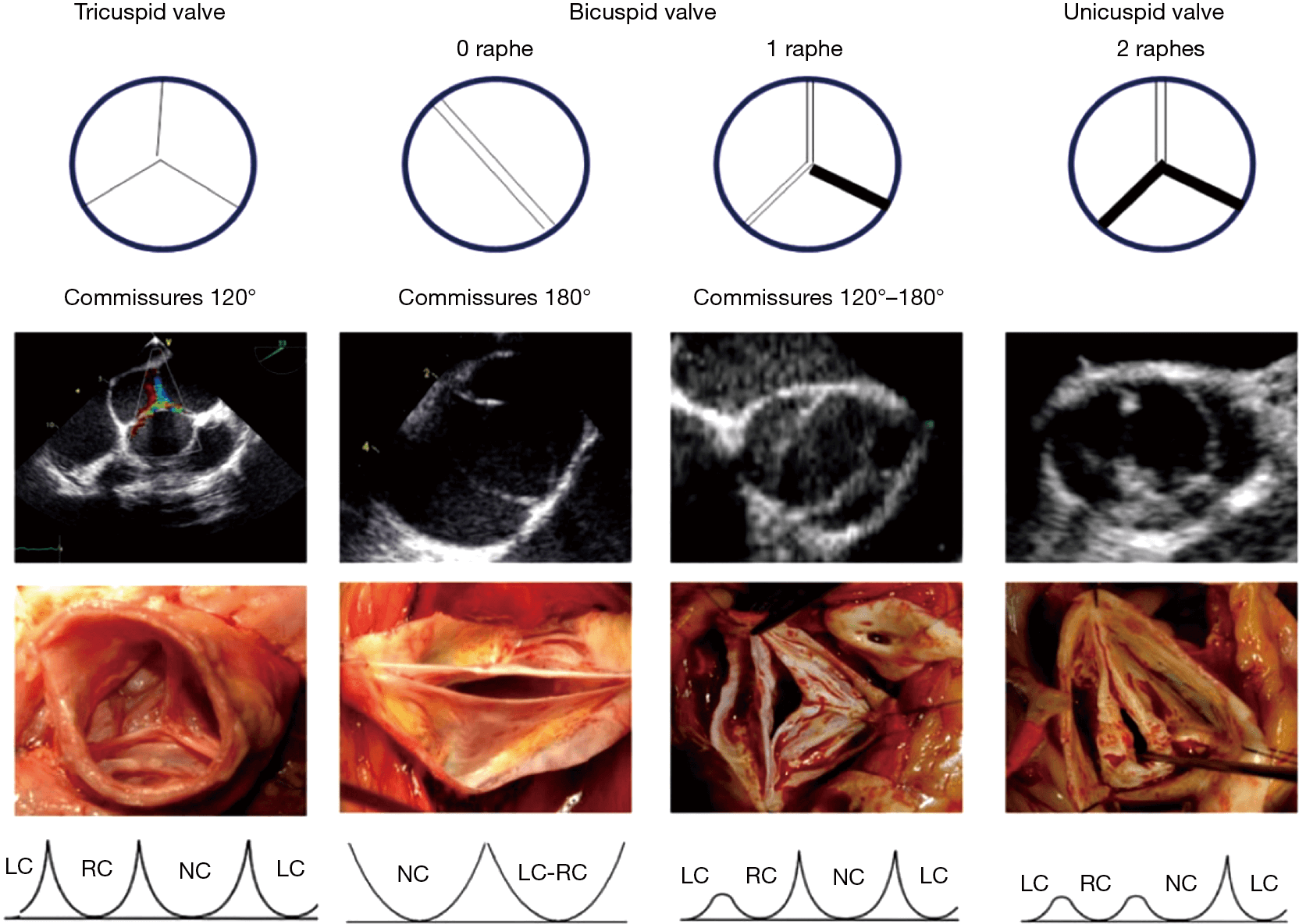 Systematic echocardiographic assessment of aortic regurgitation—what ...
