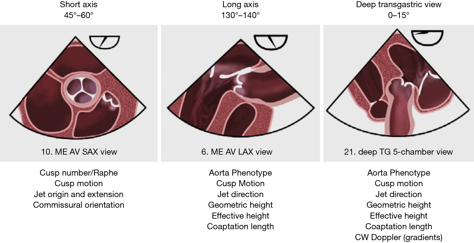 Systematic echocardiographic assessment of aortic regurgitation—what ...