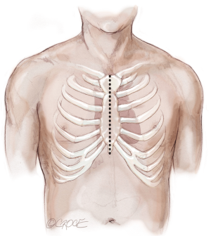 clamshell thoracotomy closure