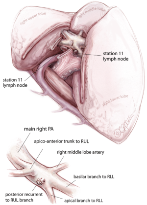 right lower lobectomy cxr