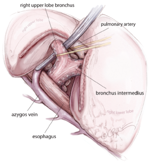 right lower lobectomy cxr