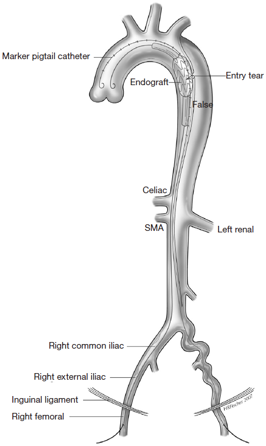 TEVAR for complicated acute type B dissection with malperfusion - van ...