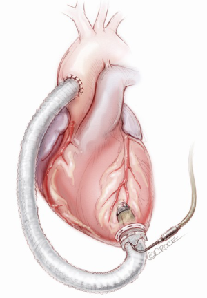 jarvik 2000 flowmaker