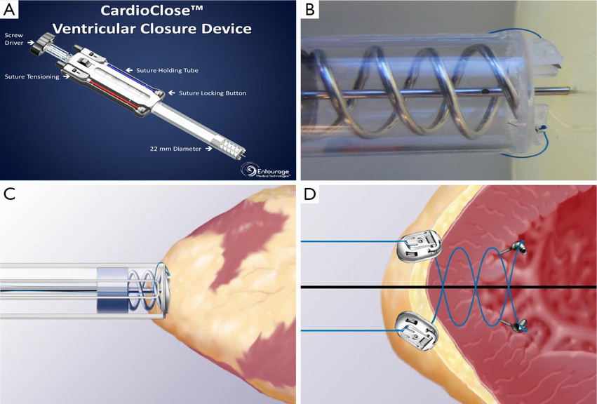 Ventricular apical access and closure, and re-access devices to ...