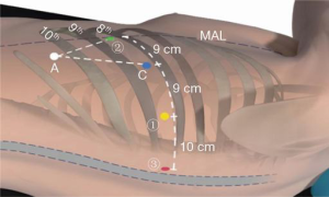 Robotic surgery for posterior mediastinal pathology - Broussard- Annals ...