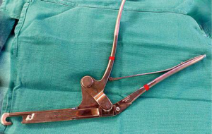 Video assisted transaxillary first rib resection in treatment of ...