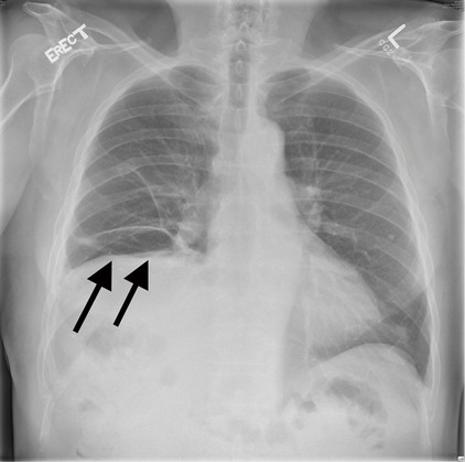 Thoracoscopic diaphragm plication - Kara- Annals of Cardiothoracic Surgery