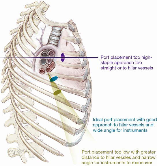 Uniportal video-assisted thoracoscopic lobectomy - Sihoe- Annals of Cardiothoracic Surgery