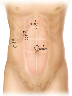 gallbladder triangle name