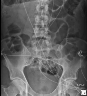 Role and timing of colonic stenting in colorectal cancer - Buxey ...