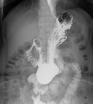 Treatment of stress incontinence secondary to chronic cough caused by ...