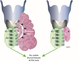 Less than total thyroidectomy for goiter: when and how? - Makay - Gland ...
