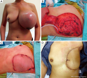 breast surgery problems