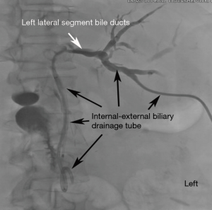 Guidelines for biliary stents and drains - Drapek - Chinese Clinical ...