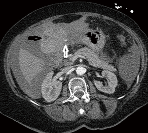 Management of ruptured liver segment IV hepatocellular carcinoma: is ...