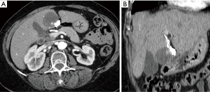 Management of ruptured liver segment IV hepatocellular carcinoma: is ...
