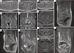 Management of presacral schwannomas—a 10-year multi-institutional ...