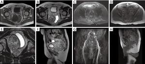 Management of presacral schwannomas—a 10-year multi-institutional ...