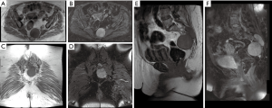 Management of presacral schwannomas—a 10-year multi-institutional ...