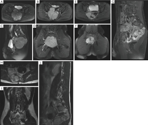 Management of presacral schwannomas—a 10-year multi-institutional ...