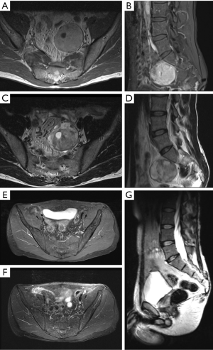 Management of presacral schwannomas—a 10-year multi-institutional ...