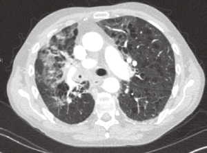 Postobstructive pneumonia in lung cancer - Valvani - Annals of ...