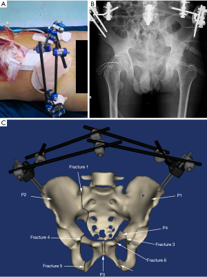 external fixation pelvis