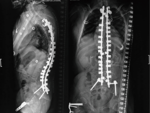 Sublaminar polyester bands for the correction of idiopathic and ...