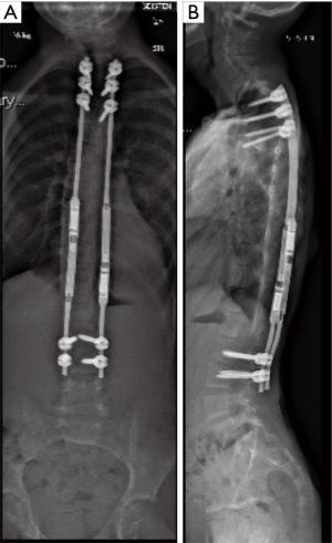 Standard and magnetically controlled growing rods for the treatment of ...
