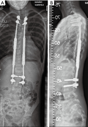 Standard and magnetically controlled growing rods for the treatment of ...