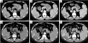 Performance of LI-RADS version 2018 CT treatment response algorithm in ...
