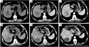 Performance of LI-RADS version 2018 CT treatment response algorithm in ...