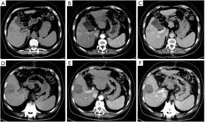 Performance of LI-RADS version 2018 CT treatment response algorithm in ...