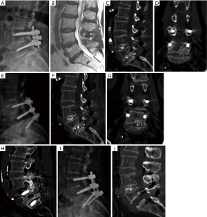 Risk factors for cage retropulsion after transforaminal lumbar ...