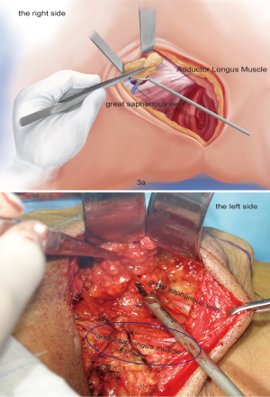 vulvectomy operation