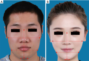 Necessity of facial contouring in feminization surgery for Chinese ...
