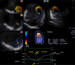 Left ventricular rotational abnormalities in patients with ...