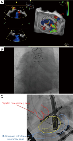Percutaneous transapical closure of paravalvular leak in bioprosthetic ...