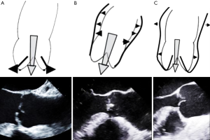 Aortic valve repair in adult congenital heart disease - Girdauskas ...