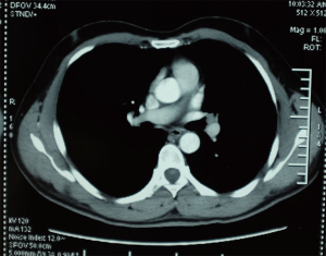 Left upper lobectomy with bronchoplasty in uniportal video-assisted ...