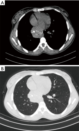 Right pneumonectomy for carcinoid tumor extending through the ...