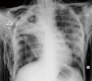 necrotizing pneumonia bronchoscopy