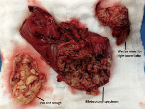 necrotizing pneumonia bronchoscopy