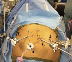 Robotic Ivor Lewis esophagectomy: evolving technique to optimize ...