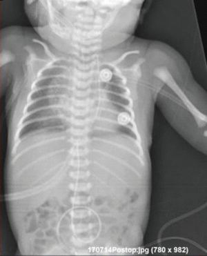 sternal cleft slideshare